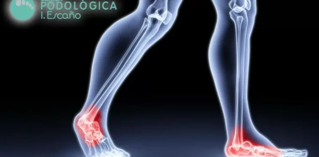 Atrapamiento del nervio de Baxter - Clínica Podológica Escaño